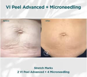 Best Tummy Skin Tightening Treatments | Youthful Obession