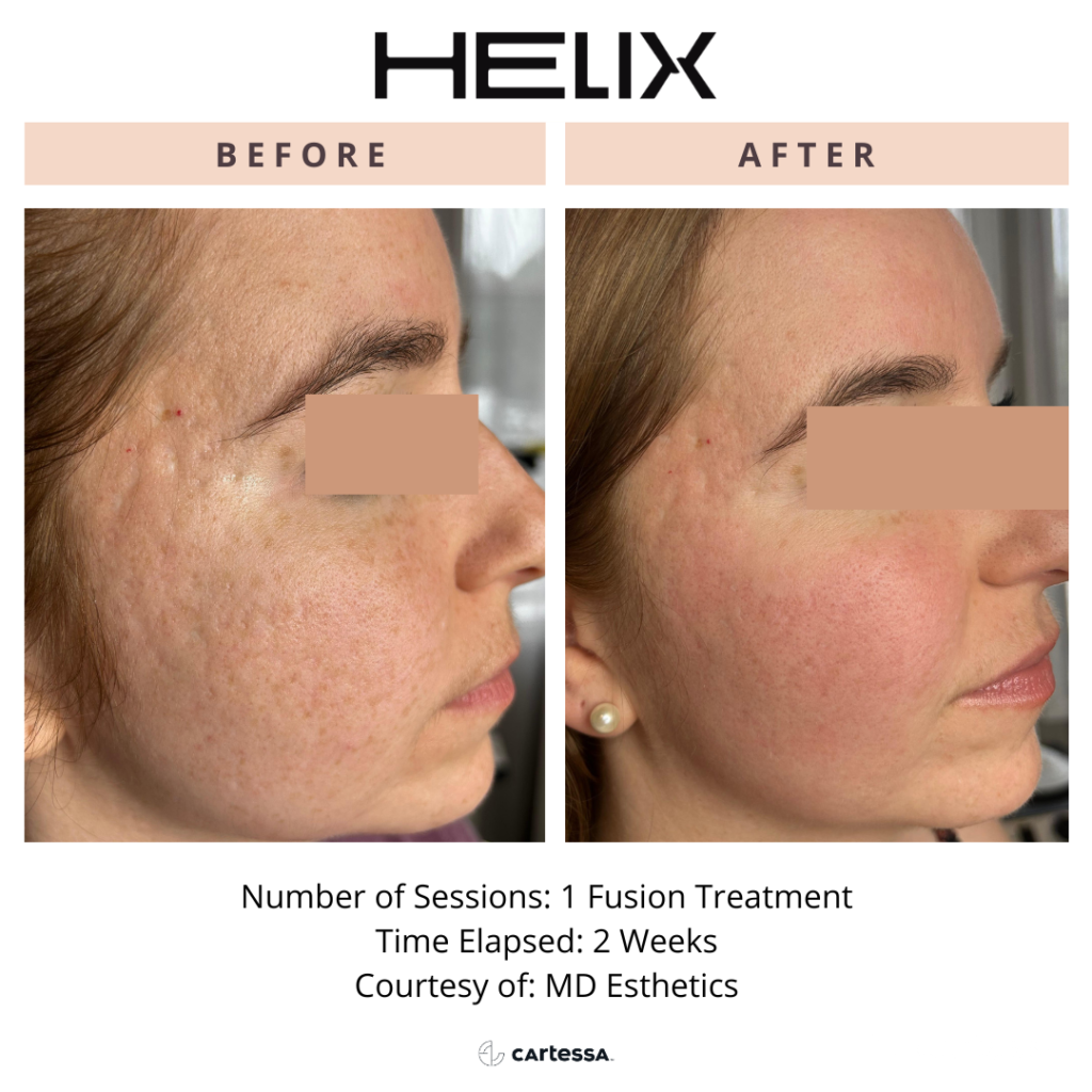 Helix Laser - Youthful Obsession Helix Laser - Youthful Obsession